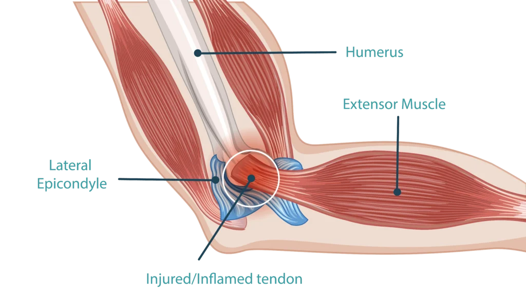 Can Tennis Elbow Cause Shoulder Pain? - Jessica Churchill, MD